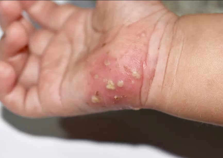 Doctor Explains Scabies Skin Rash: Symptoms, Photos, Treatment, and ...